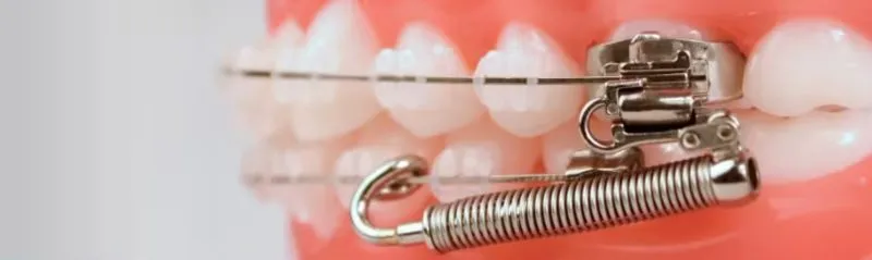 Forsus Appliance Gilbert Arizona | Orthodontist